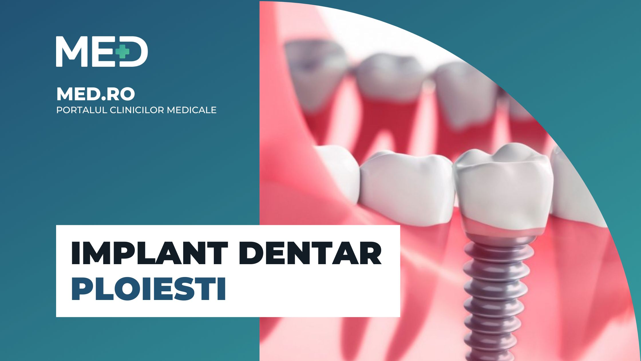Implant Dentar Ploiesti - Top 5 Clinici verificate - Med.ro