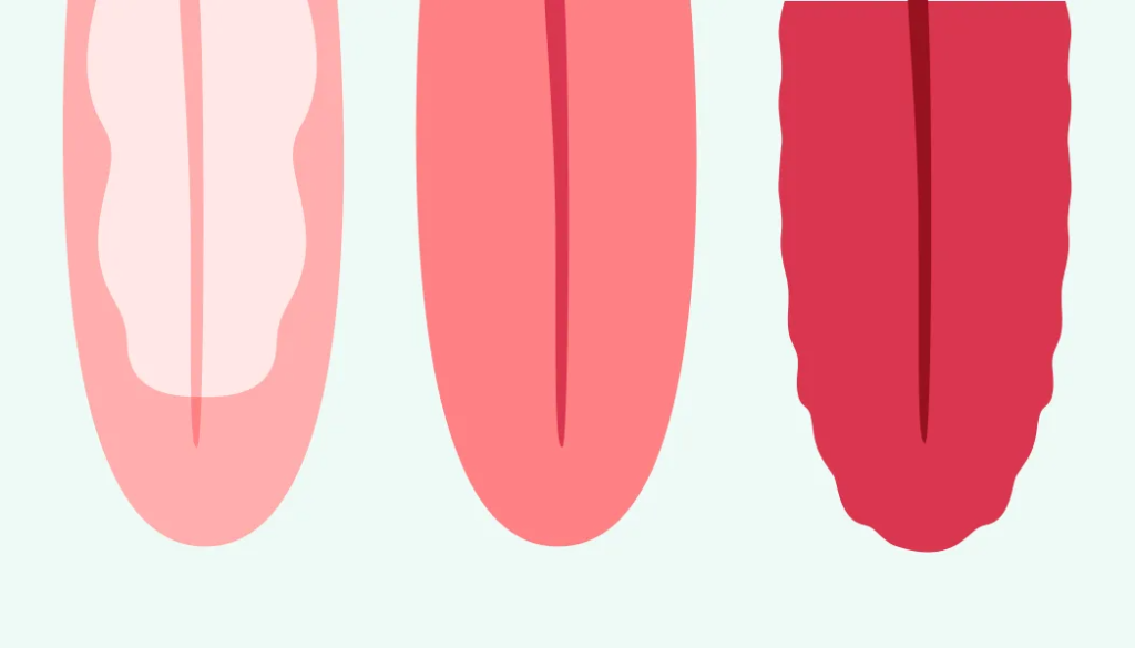 Limba Rosie - Tratament si cauzele pentru iritatie & usturimi